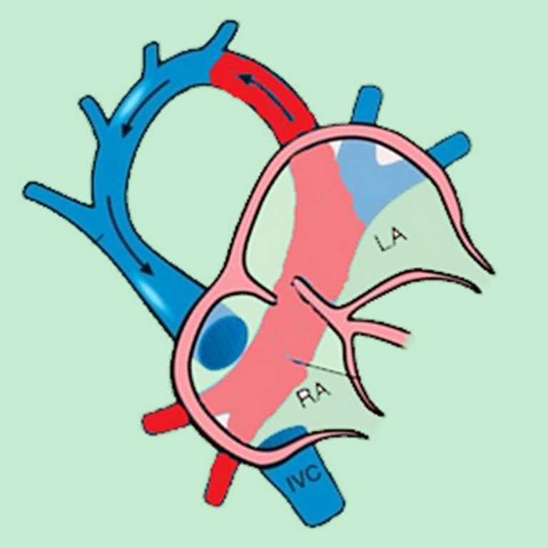 Anomalous Pulmonary Venous Connection - SonoShare