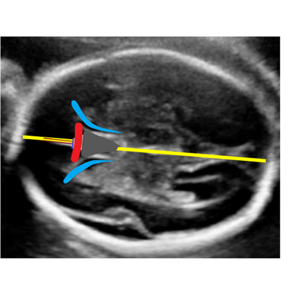 Fetal Central Nervous System - SonoShare