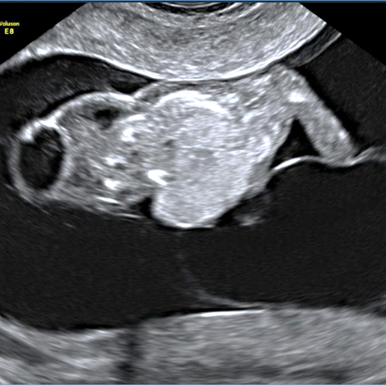 First Trimester Anomaly Scan - SonoShare
