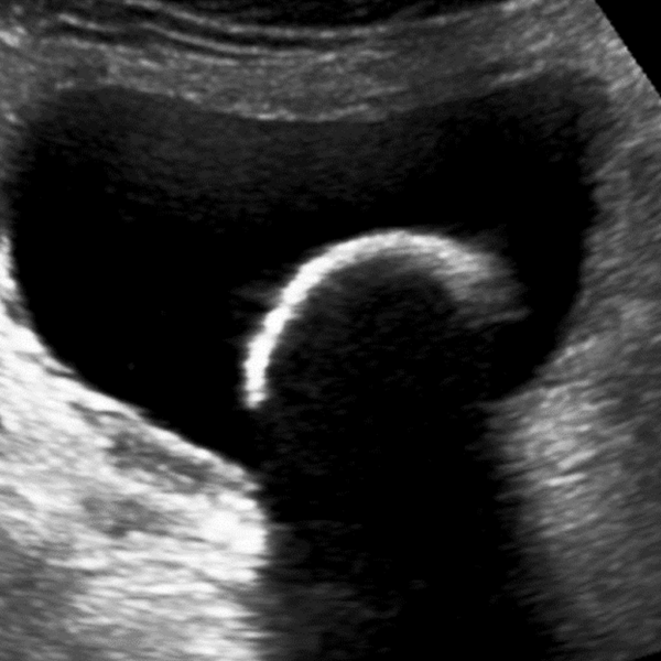 Urinary Tract – Calculi & Calcifications – Ureter & Bladder - SonoShare